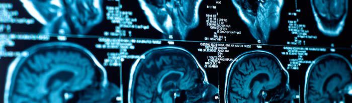 Neuroimmunology testing - Immunology Laboratory - Oxford University ...