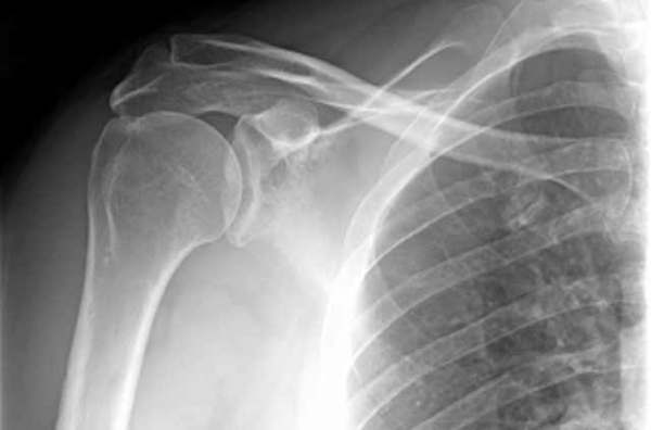 Shoulder and Elbow - Oxford University Hospitals